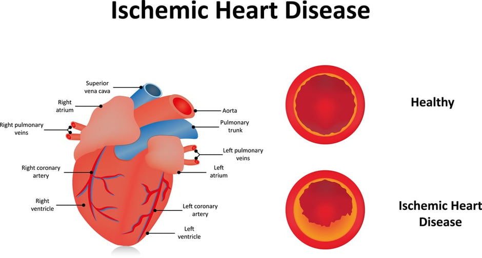 What are Ischemic heart diseases